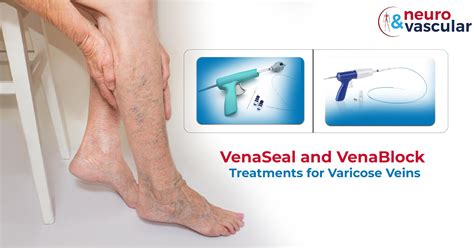 Vena Block VenaSeal Treatments For Varicose Veins