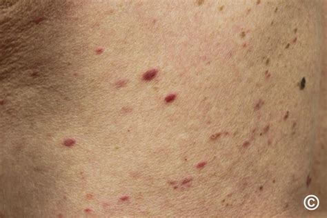 Drug Rashes Mild To Moderate