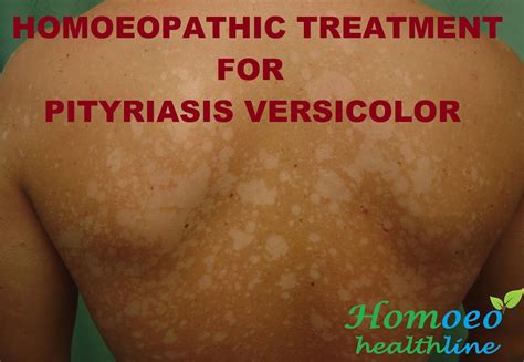 Pityriasis Versicolor Symptoms Diagnosis And Treatment