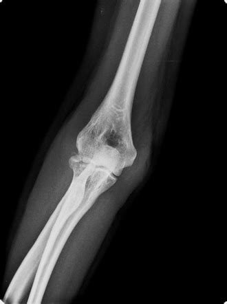 Radial Head Fracture Dislocation Image Radiopaedia Org