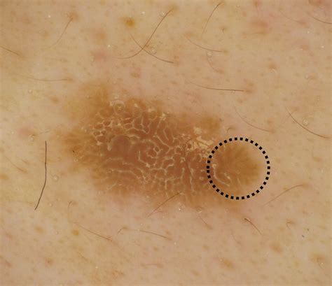 Seborrheic Keratosis Dermoscopy