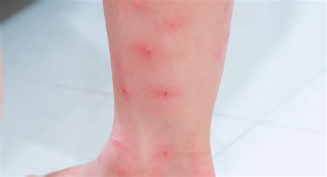 Cómo identificar qué insecto te ha picado mosquito avispa