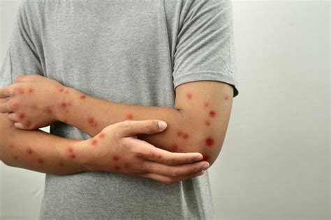 Jornal Correio Mpox EUA Identificam Primeiro Caso De Nova Cepa Em