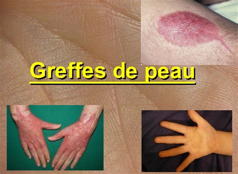 Transplantation Peau Greffe Peau Peau Transplantation