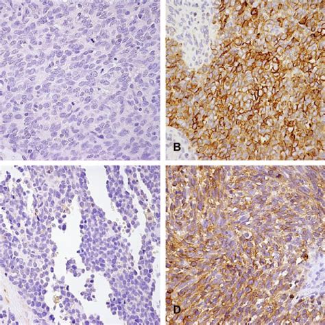 Immunohistochemical Staining Of CD56 In Undifferentiated Soft Tissue