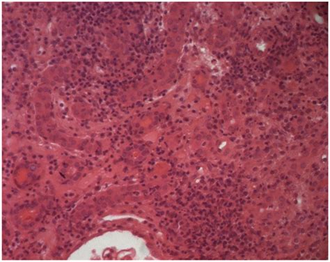 Giardia Lamblia Causes Hemolytic Anemia Bruin Blog