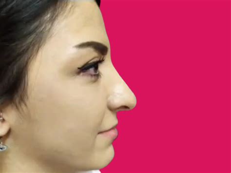 Startseite Op Dr Murat Koçyiğit Rhinoplastik Gesichtsästhetische