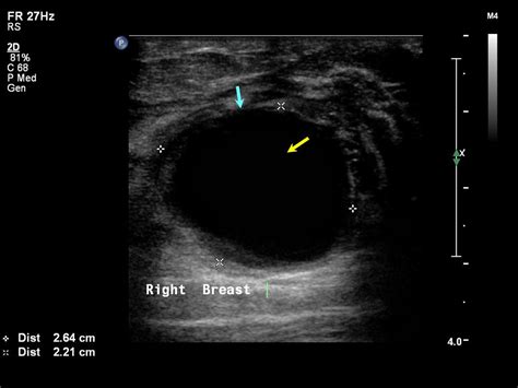 Atlas Of Breast Cancer Early Detection