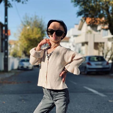 Cláudia Amaral a portuguesa que faleceu aos 23 anos devido à progeria