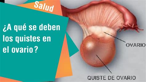 Que Son Los Quistes En La Matriz Y Porque Salen