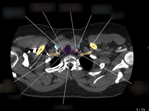 Radiology Case Stack Axial Soft Tissue Window Diagram Quizlet