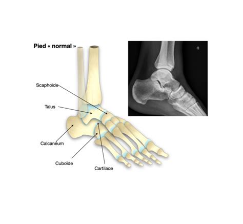 Arthrose sous talienne et médiotarsienne Dr Bovier Lapierre