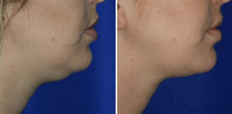 The Benefits Of Chin Liposuction Houston Lipo Center