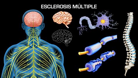 De Mayo D A Mundial De La Esclerosis M Ltiple Andaluc A M Dica