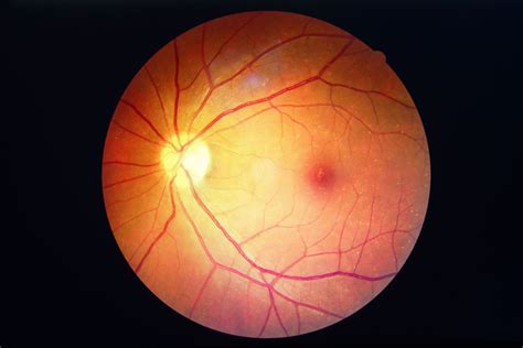 Top 77 Imagen A Quoi Sert L Examen Du Fond De L Oeil Fr Thptnganamst