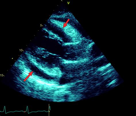 A Conundrum Of Diagnostic Analogy Between Constrictive Pericarditis And