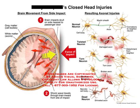 Amicus Illustration Of Amicus Injury Head Closed Brain Axonal Impact