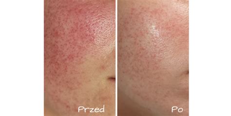 LASEROWA TERAPIA TRĄDZIKU RÓŻOWATEGO ToTu Day Spa