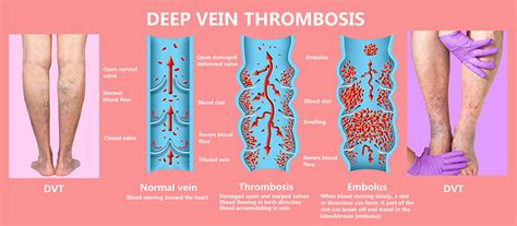 Deep Vein Thrombosis DVT Treatment Dr C Raghu