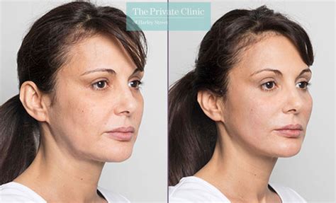 Brow Thread Lift Before After