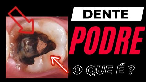 Dente podre O que é YouTube