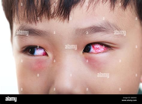 Primer plano de una conjuntivitis crónica con un iris de color rojo