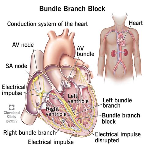 Left Bundle Branch Block Causes Symptoms Treatment Off