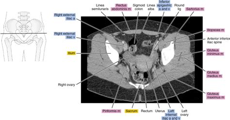CT Of The Female Pelvis Radiology Key