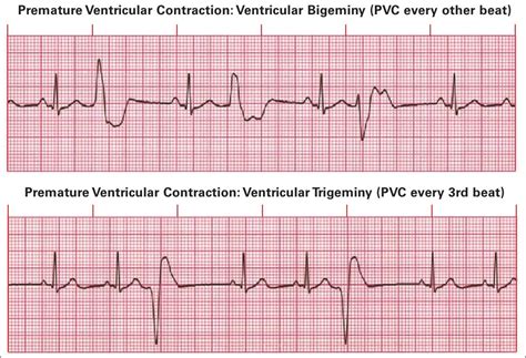 Premature Ventricular Contractions Pvcs Example 1 Images And Photos