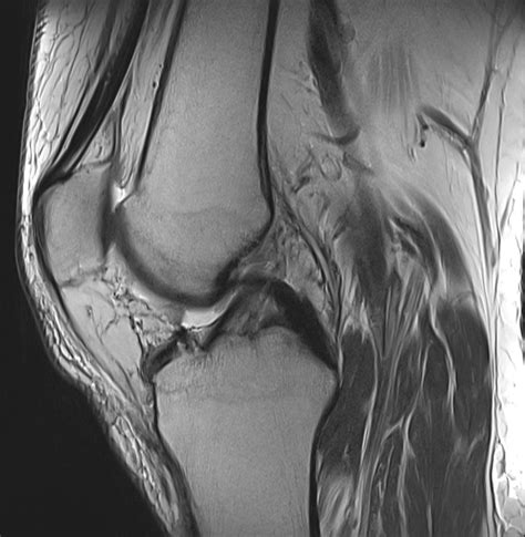 Femoral Subchondral Insufficiency Fracture Treated By