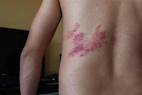 Herpes zóster principais sintomas e como tratar PrePara ENEM
