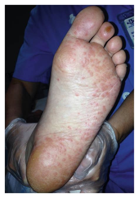 Secondary Syphilis Maculopapular Lesions On Bottom Of The Foot Download Scientific Diagram
