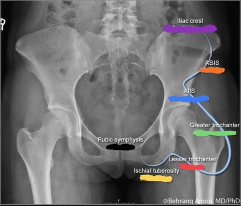 Pelvis Hip Flashcards Quizlet
