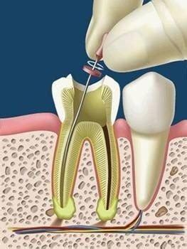 Endodoncias dentales en Valencia Clínica Dental Almar