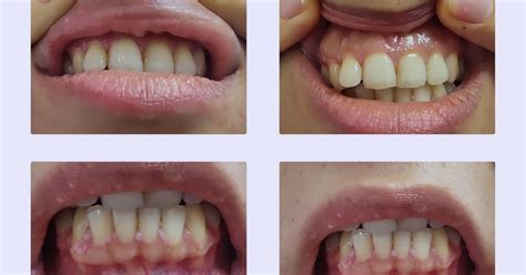 Hpv White Bumps On Tongue