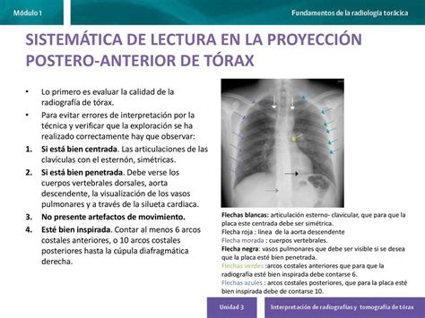INTERPRETACIÓN DE RADIOGRAFÍAS Y TOMOGRAFÍA DE TÓRAX ppt descargar