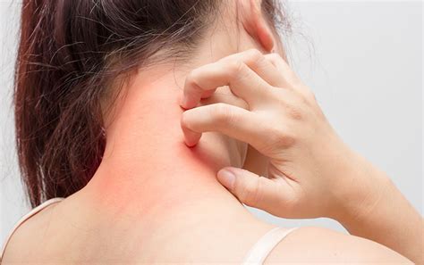 Tại Sao Cơ Thể Nổi Mẩn Ngứa Khi Trời Nóng Cách Điều Trị Cleanipedia