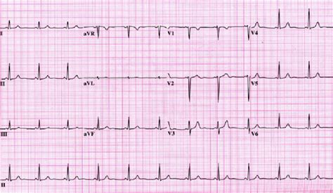Tot Ce Trebuie Sa Stii Despre Un EKG La Ce Sa Te Astepti In Timpul