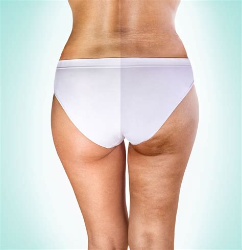 Cavitación vs Mesoterapia Cuál es la mejor opción MESOTERAPIA 2024