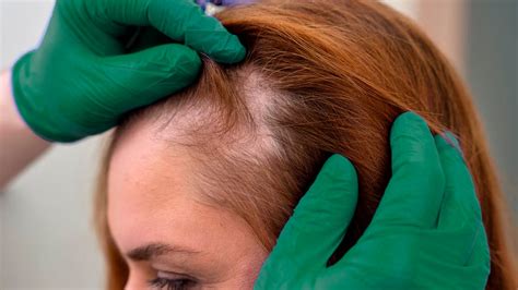 S Ntomas Y Tratamiento De La Alopecia High Supreme