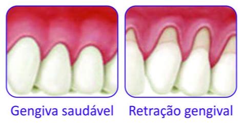 Retração gengival é reversível ImplArt Recobrimento de raiz dental