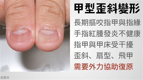 大拇指常見問題 甲溝炎 凹凸不平 歪斜變形 甲床分離 黑線白點