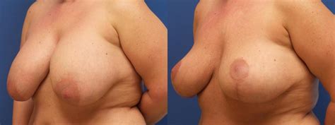 Nipple Reduction Case 222