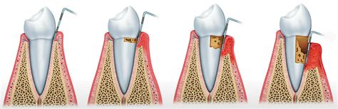 Encías retraídas Síntomas causas y tratamiento Clínica dental