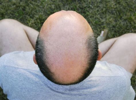 Hair Transplant Vs Replacement Why Transplant Wins