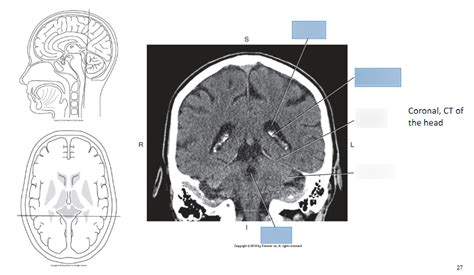 Coronal Brain Ct Diagram Quizlet