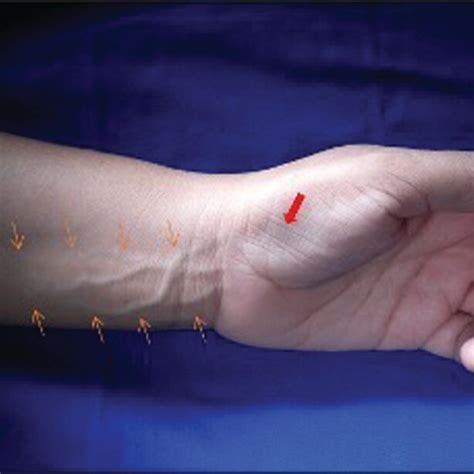 Large Mass In The Volar Aspect Of The Distal Forearm Orange Arrows