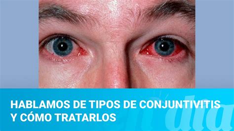 Hablamos De Tipos De Conjuntivitis Y C Mo Tratarlos Youtube
