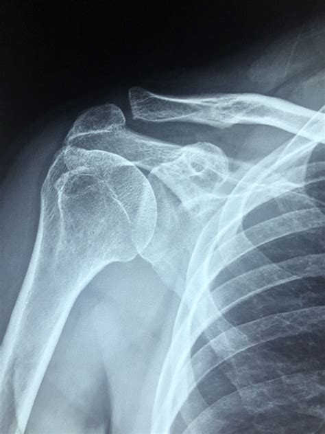 Optimizing Tissue Engineering In Rotator Cuff Repair