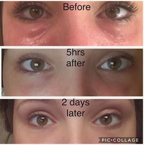 PRP Under Eye Treatment Here S What You Should Know Beverly Hills RN